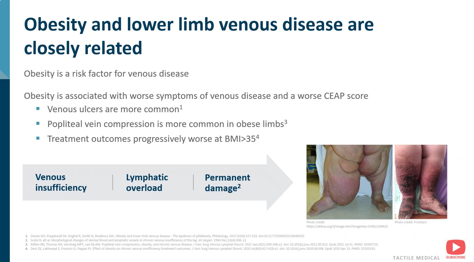 Physical Therapy Course 6 – Obesity-Related Lymphedema - Tactile ...